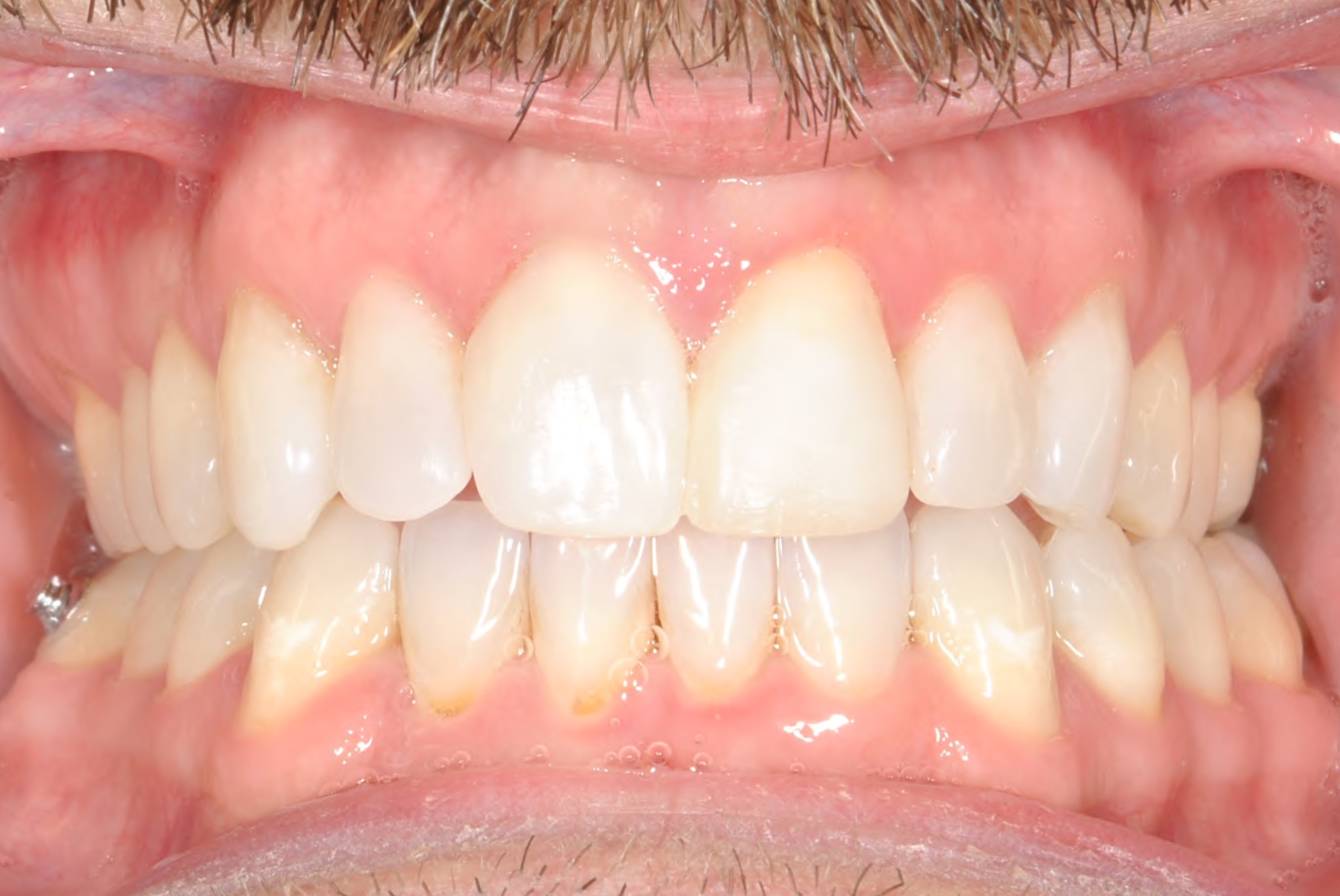 Treatment Adults - Olson Orthodontics