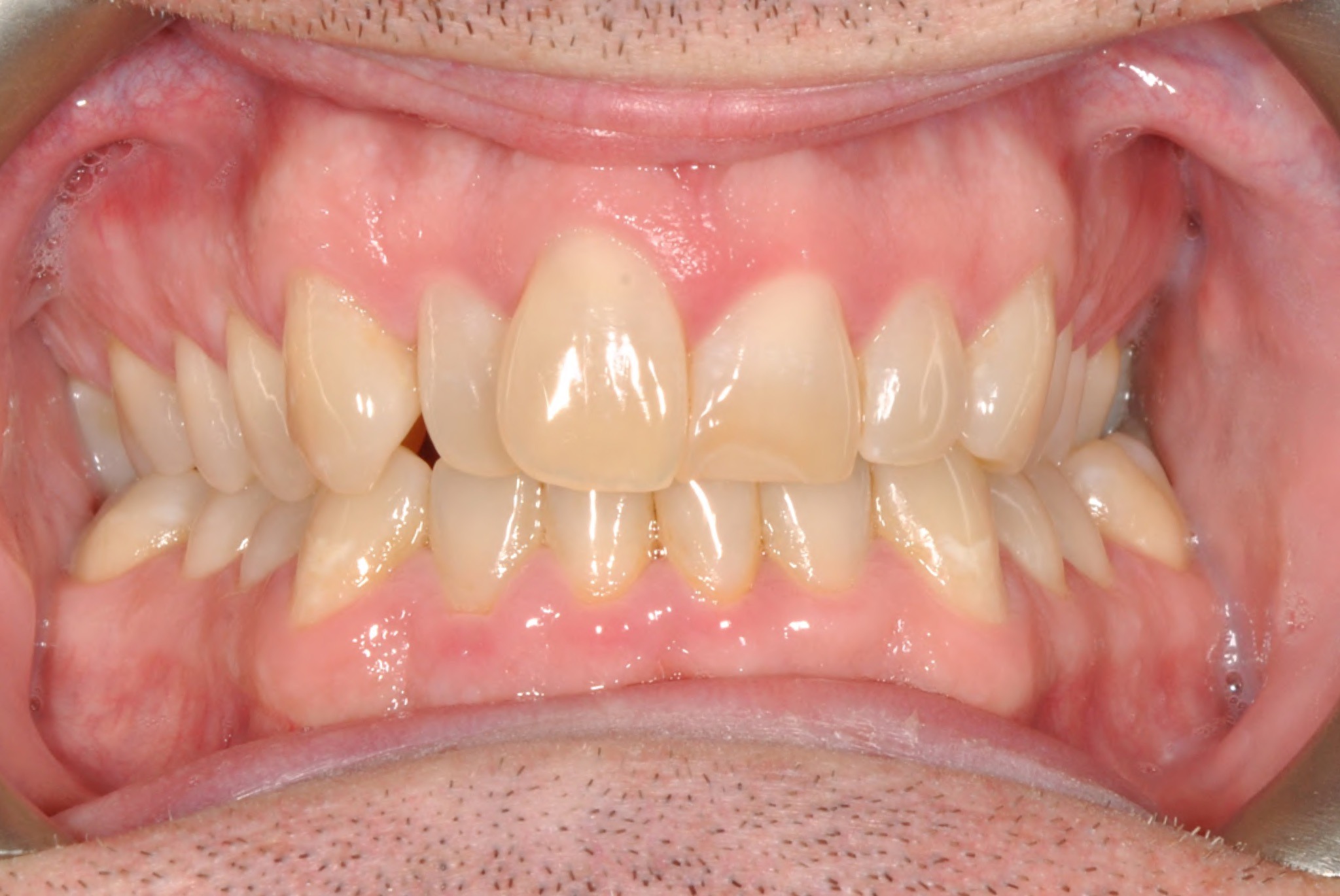 Treatment Adults - Olson Orthodontics