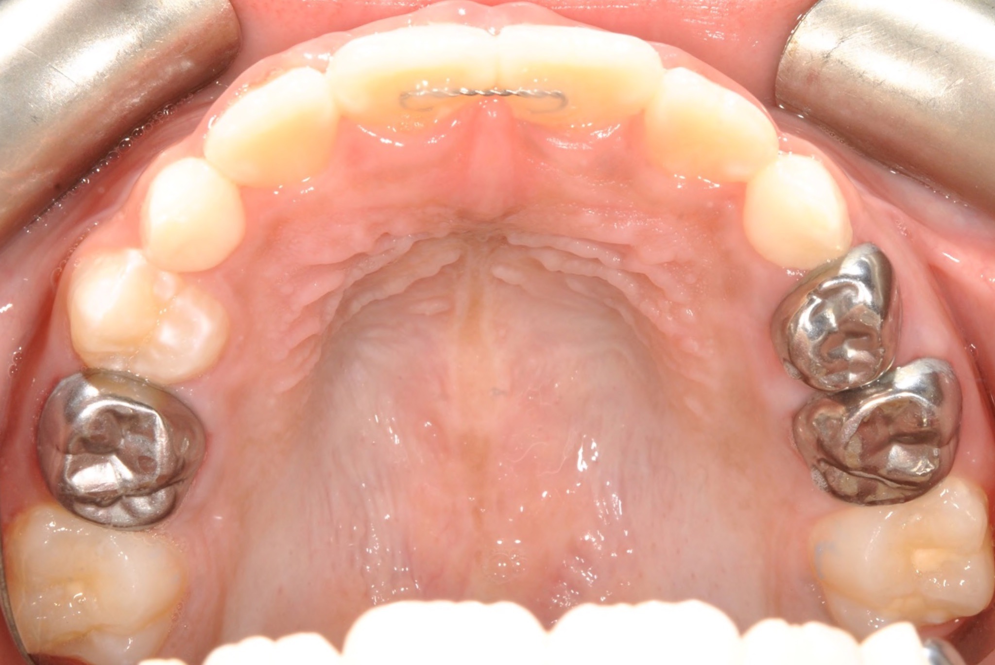 Treatment Children - Olson Orthodontics