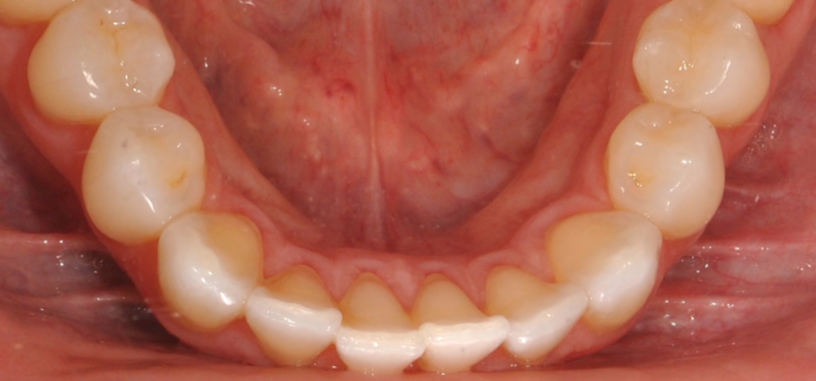 Virtual Treatment - Olson Orthodontics
