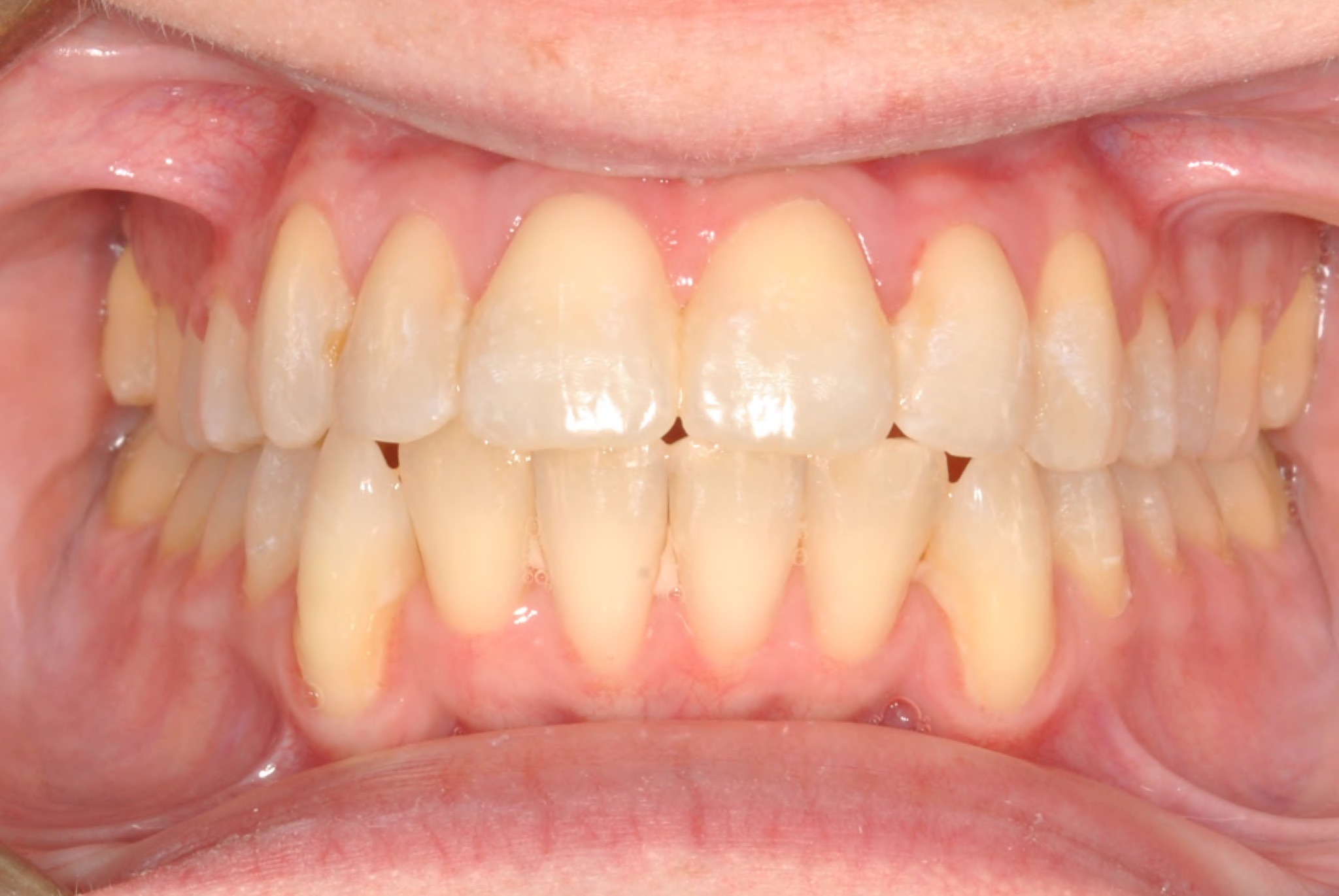 Before and After - Olson Orthodontics