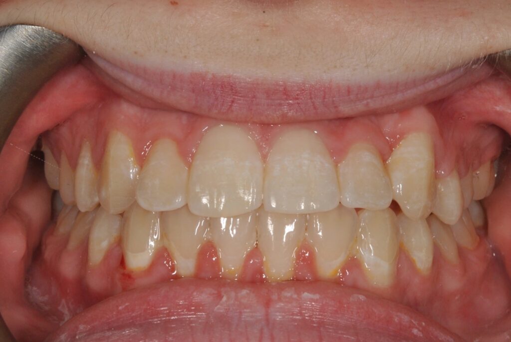 Before and After - Olson Orthodontics