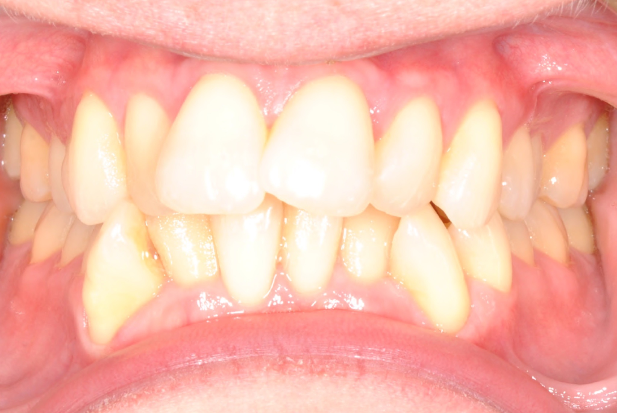 Before and After - Olson Orthodontics